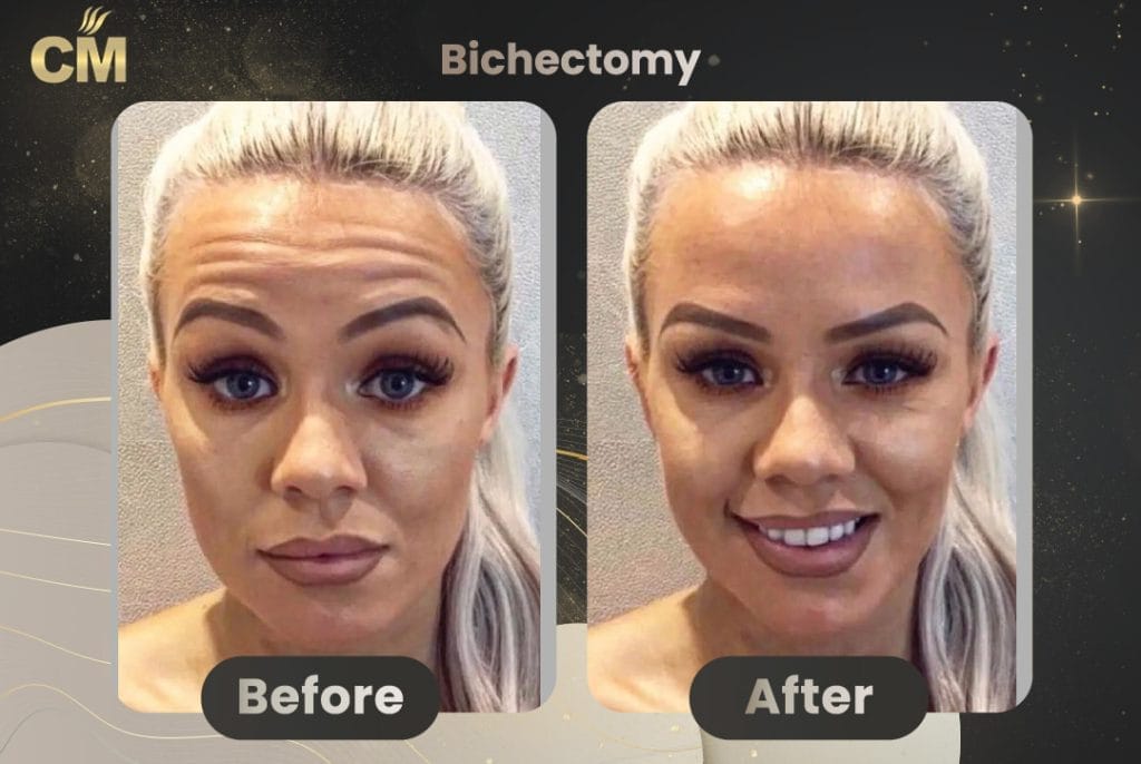 Get Inspired: Bichectomy Before After Results in Turkey