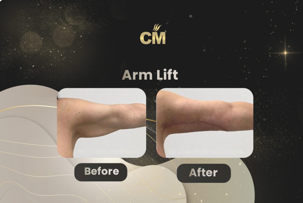 Arm Lift Before and After in Turkey: What to Expect