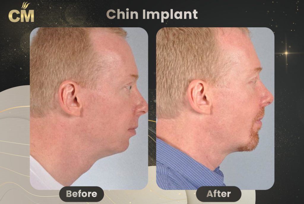 Chin Implant Surgery In Turkey | Overview of Mentoplasty