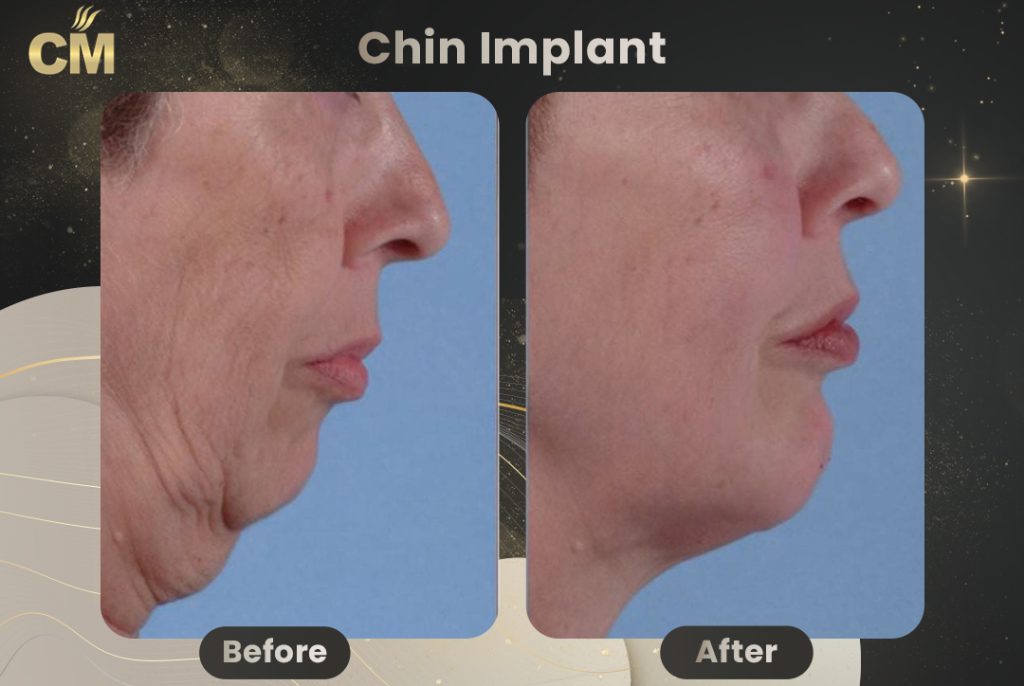 Chin Implant Surgery In Turkey | Overview of Mentoplasty