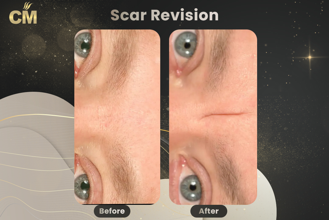 Z-Plasty Scar Revision Before After Procedure Guide